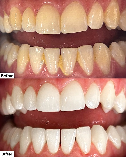 Boutique Teeth Whitening System – Glenhuntly Dental Clinic